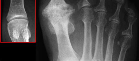 Hallux Rigidus Arthurcare