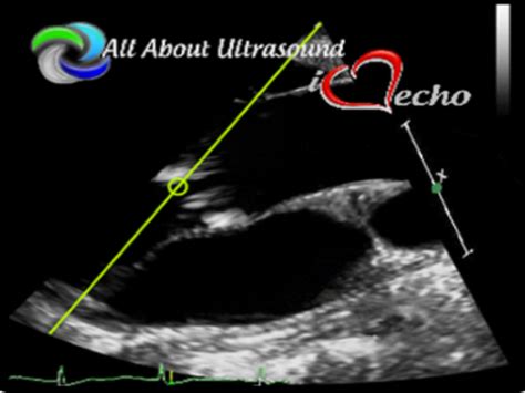 mastering aortic stenosis allaboutultrasound 2022 complete html