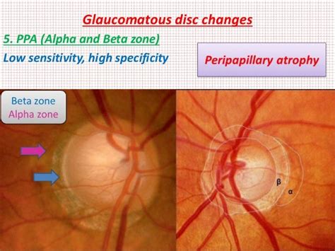 Glaucoma Basic Principles Part 1