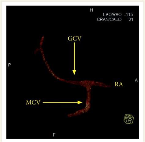 Dual Source Computed Tomography The Same Patient As In Figure 1 The Download Scientific