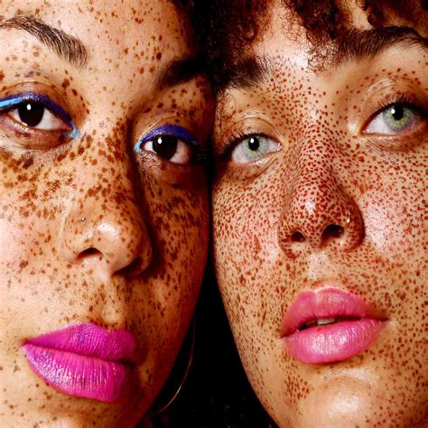 Freckles All Year Round
