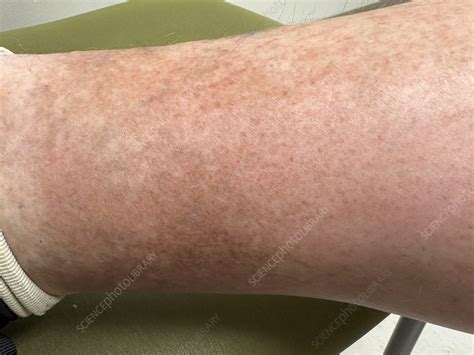 Pigmented Purpuric Dermatosis Stock Image C0607715 Science Photo