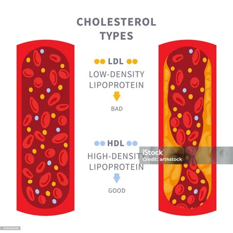 Normal And Blocked Artery With Cholesterol Clot Infographics Stock Illustration Download Image