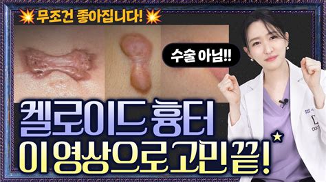 켈로이드 흉터 완벽하게 없앨 수 있나요 켈로이드 치료 켈로이드피부 Ep35 Youtube