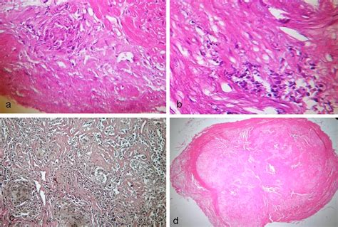 A Subendocardial Epithelioid Granuloma With Tendency To Fibrosis HE Download Scientific