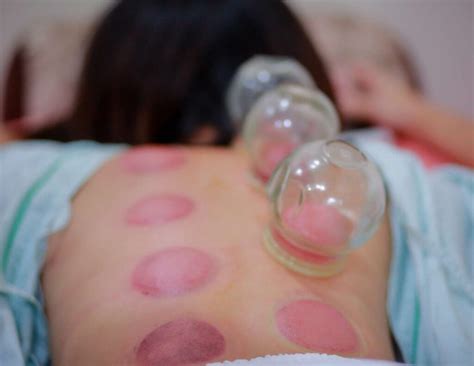 Get Relief Now Cupping For Sciatica Pain