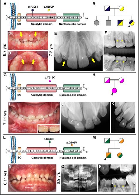 Hypercementosis Semantic Scholar