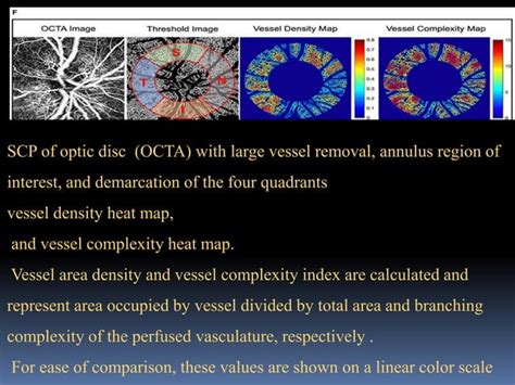 Prognostic Value Of Multiple Differential Diagnosis Of Onh By Oct Angio