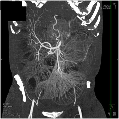 Ischemic Bowel In A Patient With Poor Cardiac Function Small Bowel