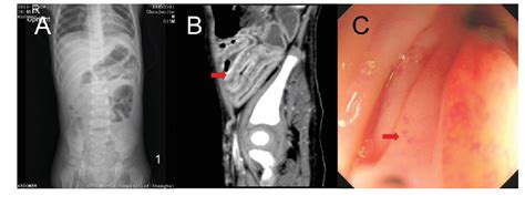 Figure 1 From Pediatric Severe Pseudomembranous Enteritis Treated With Fecal Microbiota