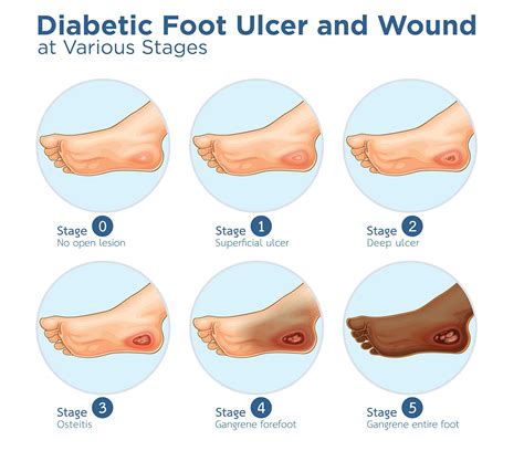 Diabetic Foot Ulcer