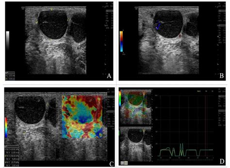 A B Mode It Presented With Homogenous Echopattern Faint Central Hilum