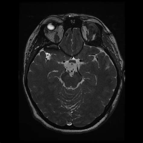 Neurovascular Compression Syndrome Trigeminal Nerve Radiopaedia 89835 106947 Axial Fiesta