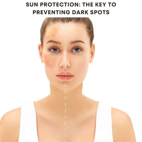 Quick And Natural Remedies To Fade Dark Spots On Your Face Clinikally