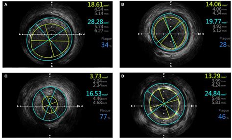 An Example Of Ivus Imaging And Analysis Of Stent Expansion A Eem Download Scientific