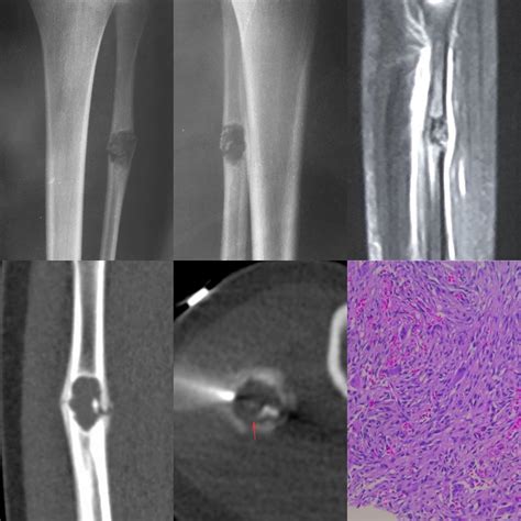 An Unusual Fibular Fibro Osseous Lesion Ref India