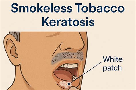 Smokeless Tobacco Keratosis Absolute Health Rome