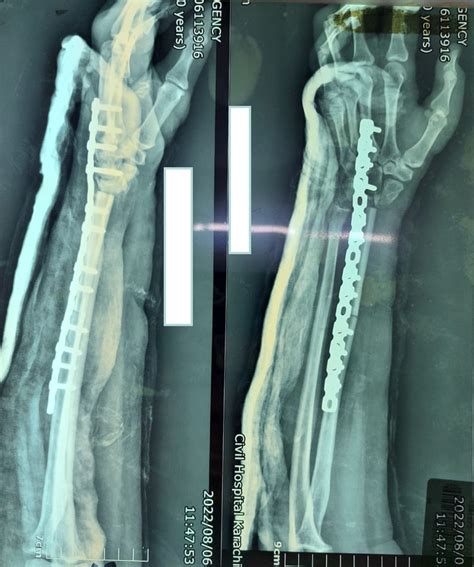 After Marginal Resection And Reconstruction With Fibular Graft And Download Scientific Diagram
