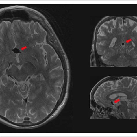 Determinants Of Volume Of Unruptured Intracranial Aneurysms Download