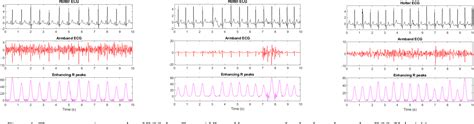 Figure 1 From Improving The Accuracy Of R Peak Detection In A Wearable