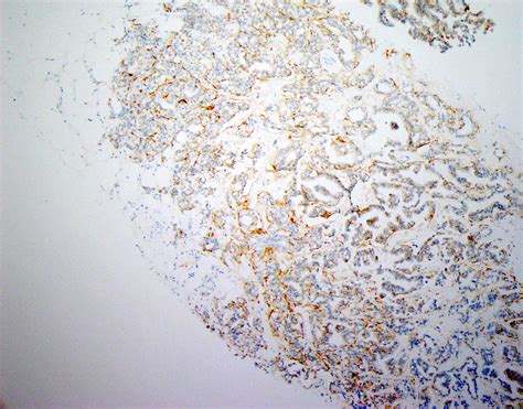 Pathology Outlines Her2 Low Breast Cancer
