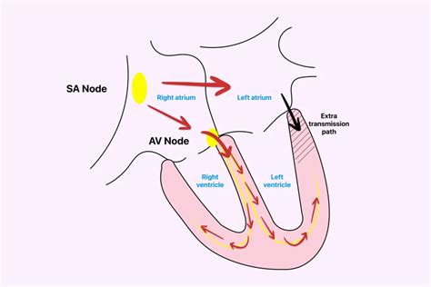Wolff Parkinson White Syndrome Is Exercise Stress Testing A