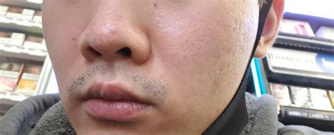 여드름흉터어떠냐 여드름 갤러리