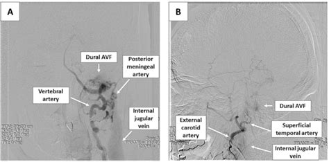 Angiogram Showing Specific Feeders And Drainers Of Dural Avf A
