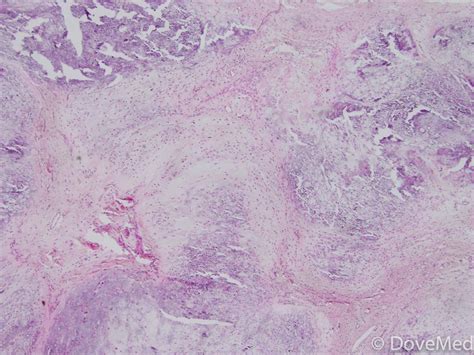 Periosteal Chondroma