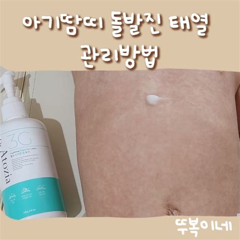 아기땀띠 돌발진 태열 침독 관리방법 수딩젤 수딩로션 닥터아토지아 네이버 블로그