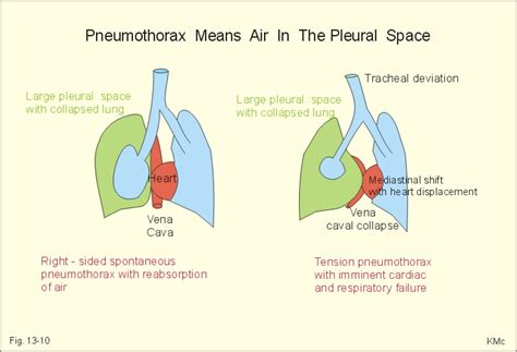 Pneumothorax Pathophysiology Pneumothorax Nursing Care And Management