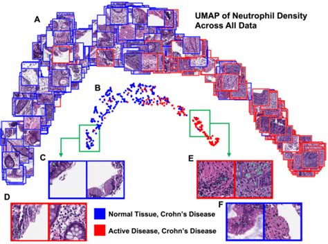 Predicting Crohns Disease Severity In The Colon Using Mixed Cell Nucleus Density From Pseudo