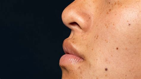 What Causes Black Spots On Face