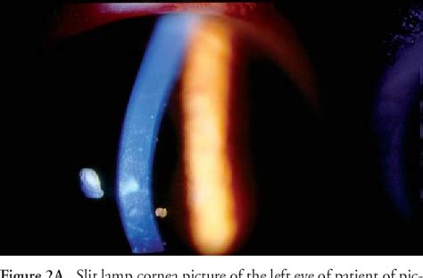 Figure 1 From Posterior Polymorphous Dystrophy And Keratoconus More