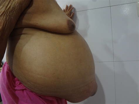 Abdomen Con Ascitis El Atlas Gastrointestinal