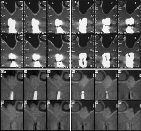 Figure 2 From Platelet Rich Plasma Activity On Maxillary Sinus Floor