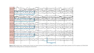 Benign Variants Of Eeg Pptx