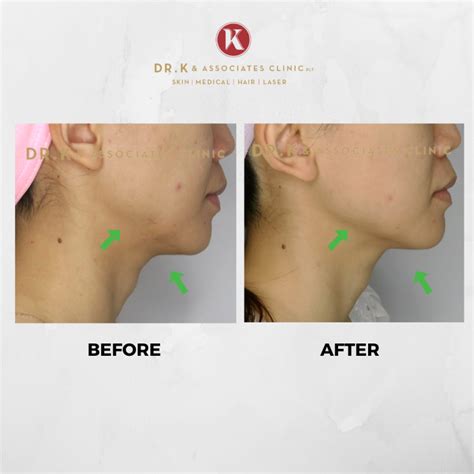 Hifu Treatment In Malaysia By Aesthetic Clinic Dr K And Associates