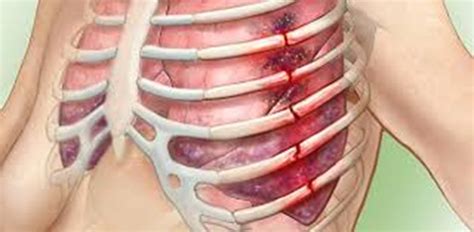 Heartburn With Broken Ribs