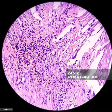 셀ar 병변에서 조직 현미경 검사법은 여러 젖은 각질 기저형 나타나는 세포 염증 세포 및 거대한 세포를 보여줍니다 진단 두개골 인두종 건강 진단에 대한 스톡 사진 및 기타