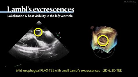 〖echocardiography〗 Lambls Excrescences And Fibroelastoma In Tee 🫀 Youtube