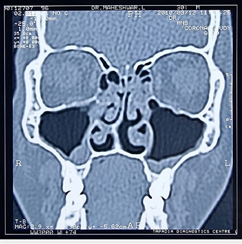 Coronal Ct Image Of Paranasal Sinuses Done In 2010 Showing A Deviated