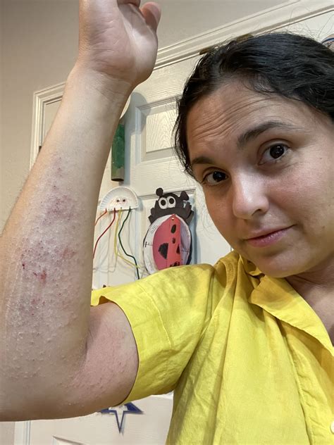 Pineapple Allergy Itchy Skin At Isaac Oppen Blog