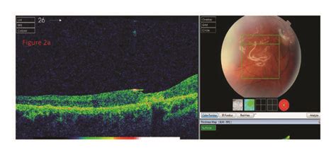 Oct Demonstrating The Closure Of The Ftmh Before A And After B