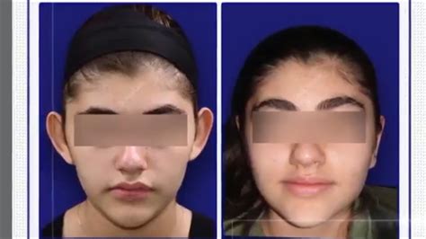 اتوپلاستی توسط دکتر خوروش نماشا