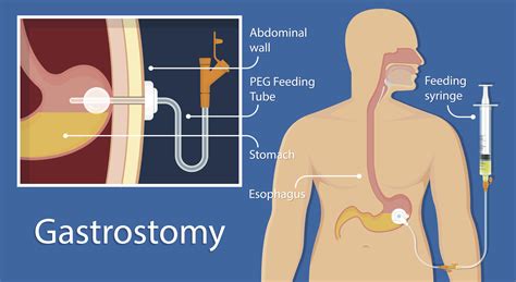 Information On Gastric Feeding Tube And Nasogastric Feeding Tube