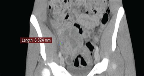 Ct Of The Abdomen Showing A Thick Walled Caecum With Adjacent Fat