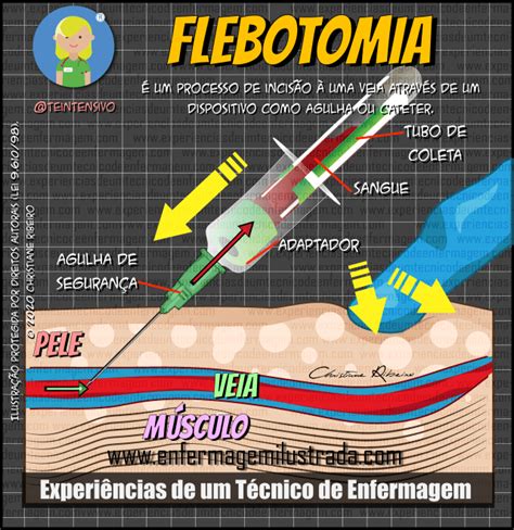 Flebotomia Entenda O Termo Enfermagem Ilustrada