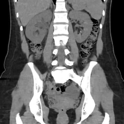 Coronal Ct Image Of A Patient With Moderate Hydronephrosis Of The Right