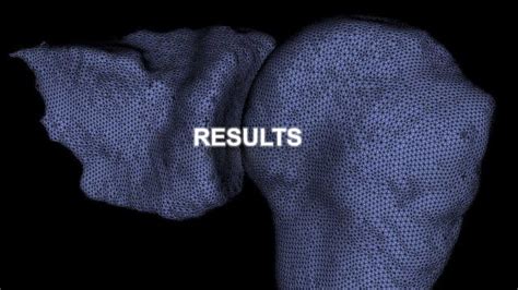 Fully Automated Mri Bone Segmentation Of Glenoid And Humeral Head Using Deep Convolutional